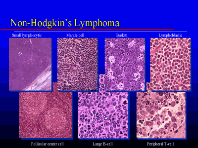 Hodgkin Lenfoma 2.Evre