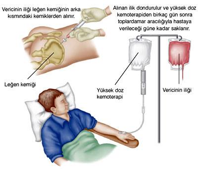 İlik Nakli Nasıl Yapılır?